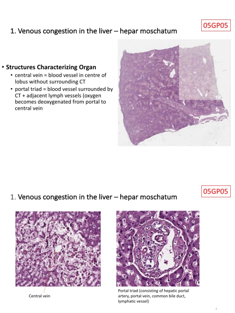 Venous Congestion in Hepar Moschatum | PDF | Liver | Epithelium
