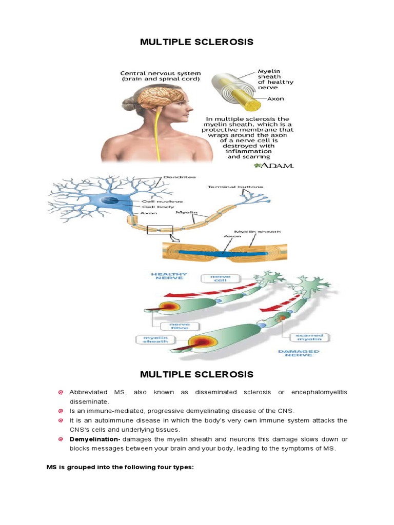 Multiple Sclerosis: Demyelination-Damages The Myelin Sheath and Neurons ...