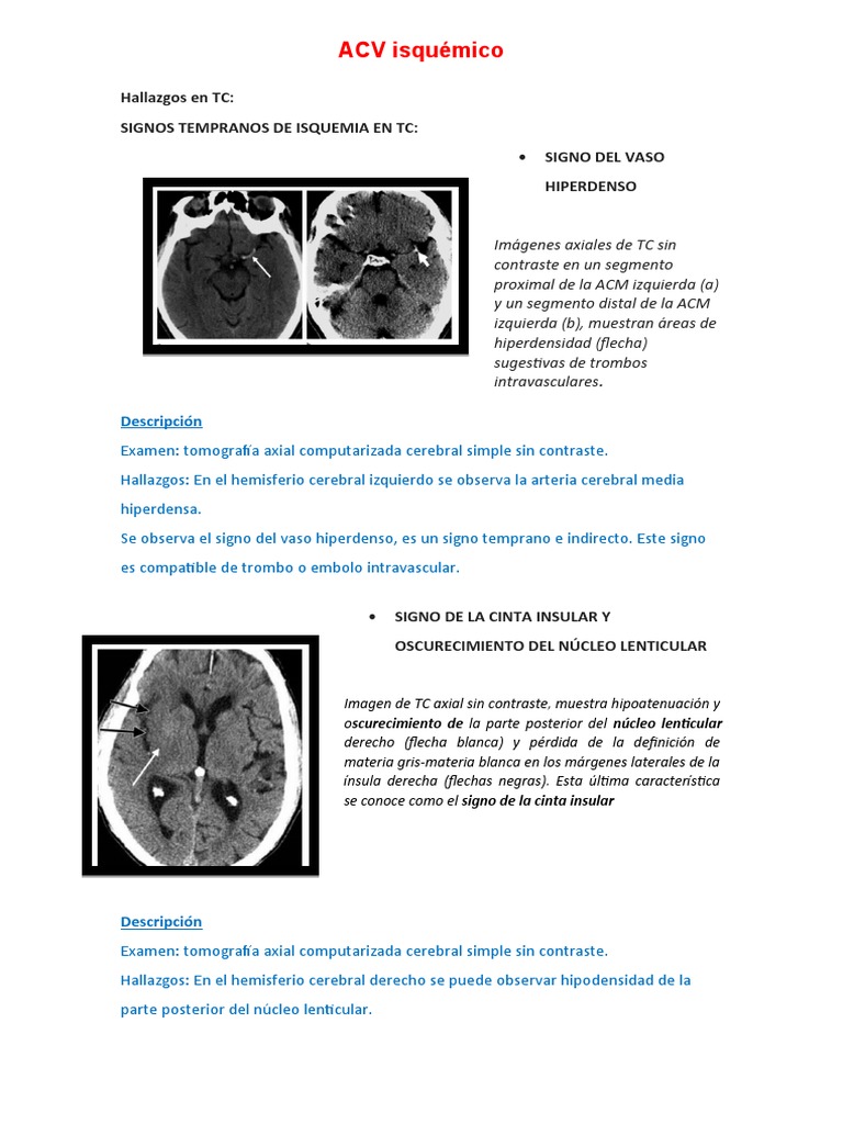 Signos tomográficos en ACV isquémico | PDF | Cerebro | Angiología