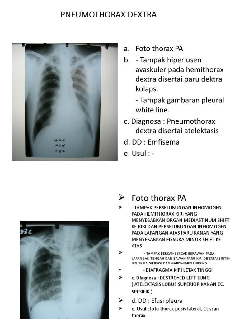 Pneumothorax Dextra | PDF