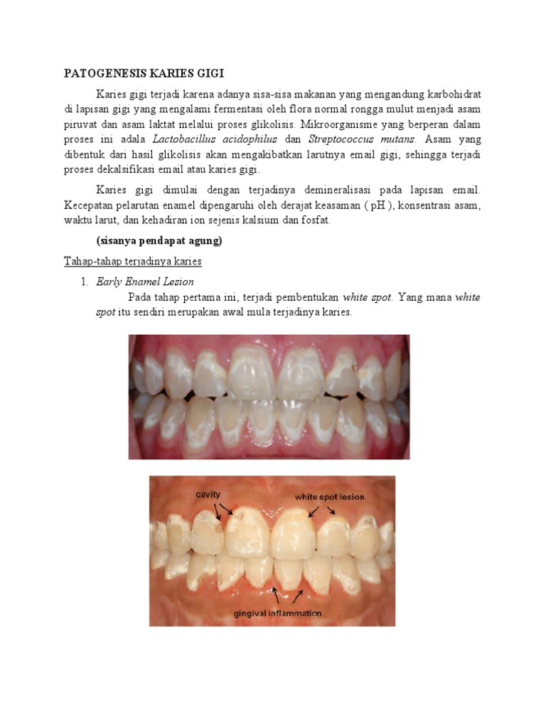 Patogenesis Karies | PDF
