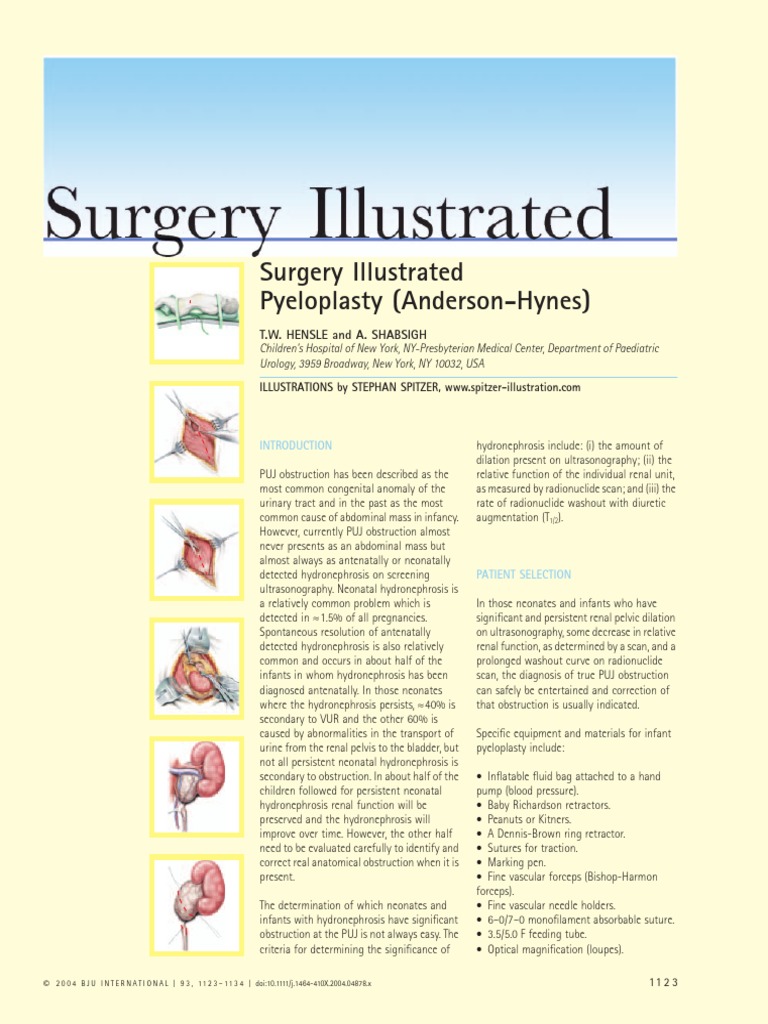 Pyeloplasty (Anderson-Hynes) | PDF | Kidney | Urology