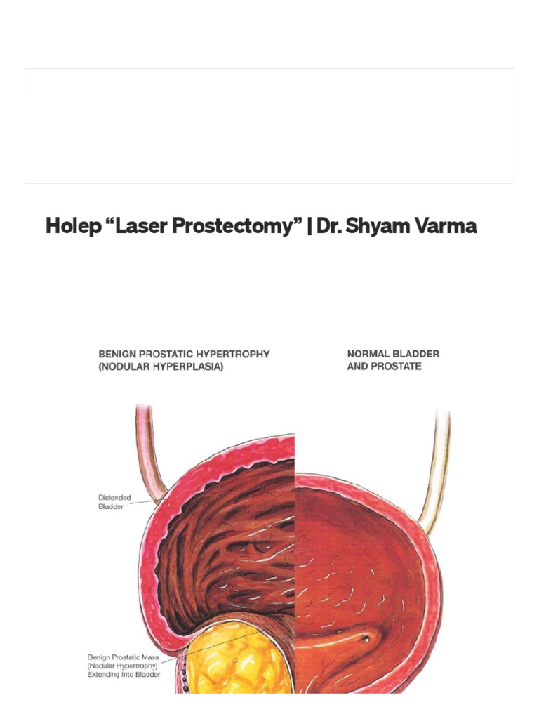 Holep Laser Prostectomy - Dr. Shyam Varma | PDF