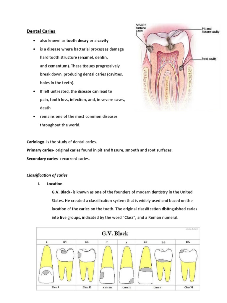 Black Caries Classification PDF, 58% OFF | www.pinnaxis.com