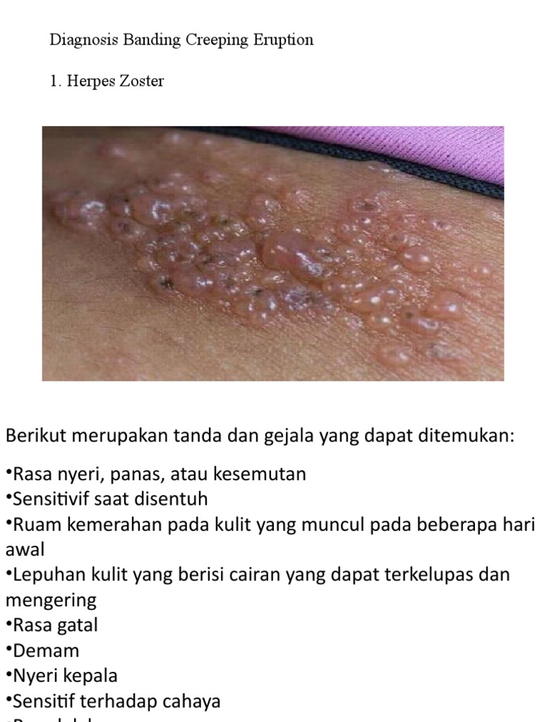 Diagnosis Banding Creeping Eruption | PDF