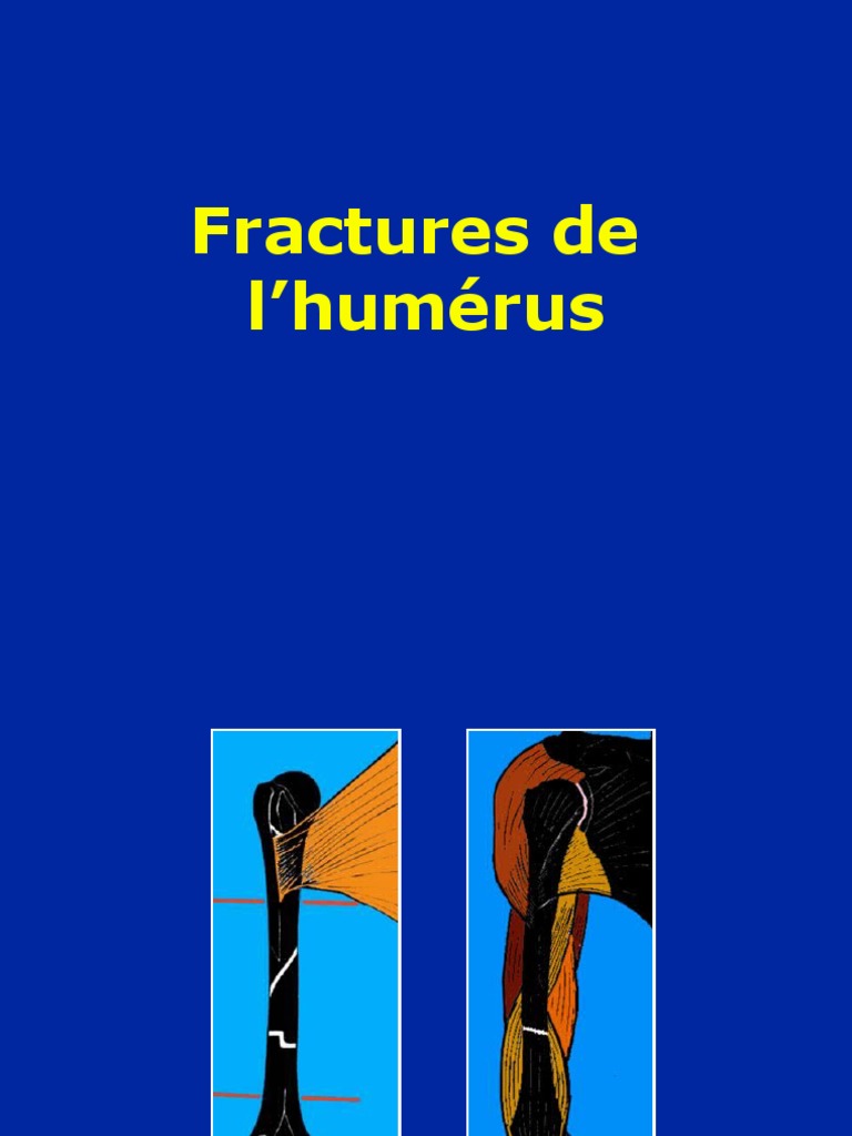 08 - Humerus - Fractures | PDF | Spécialités chirurgicales | Appareil ...