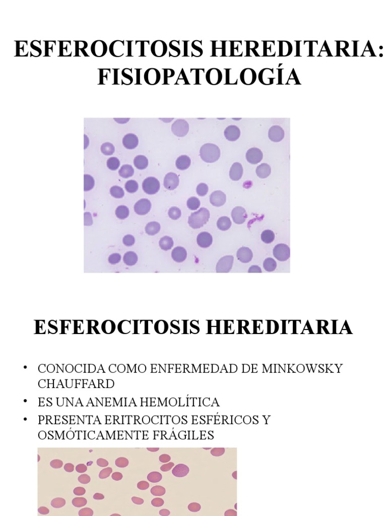 Esferocitosis Hereditaria Fisiopatología | PDF