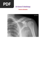 Sternoclavicular Dislocation - Trauma - Orthobullets | PDF | Anatomical ...