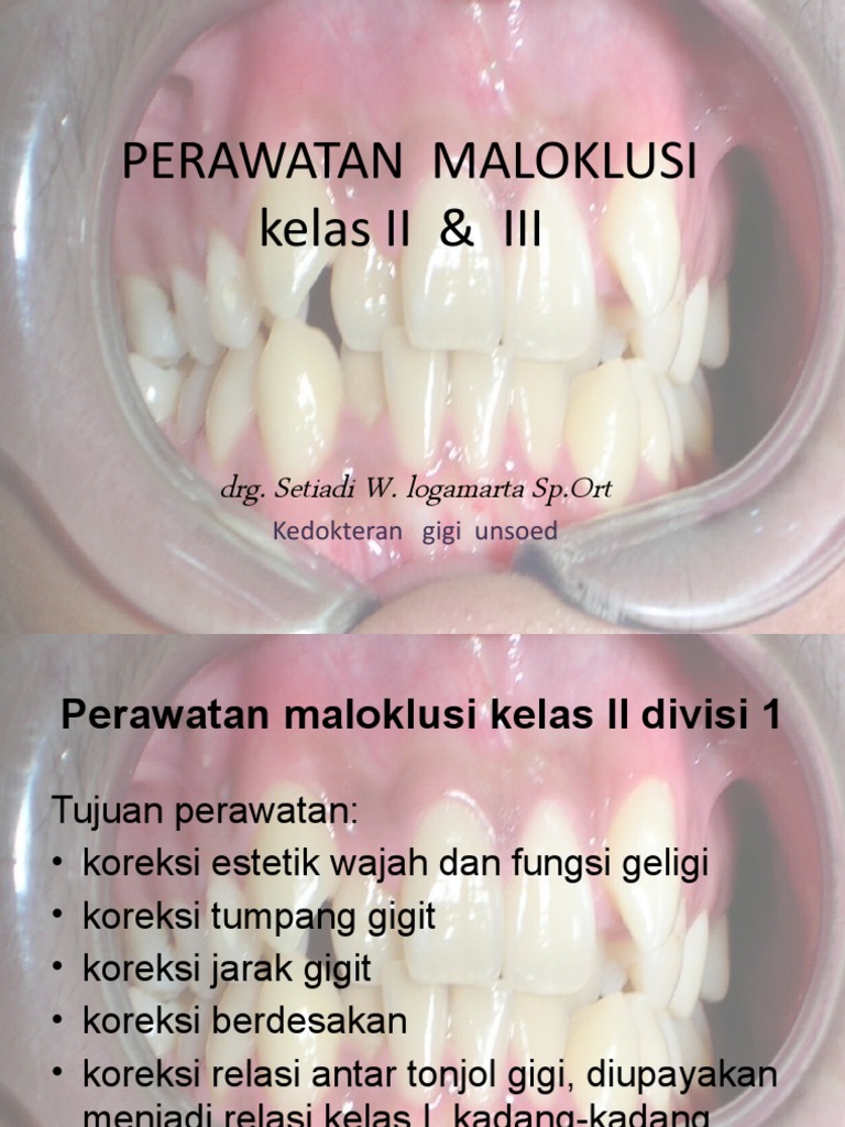 L9. Perawatan Maloklusi Kelas II - III | PDF