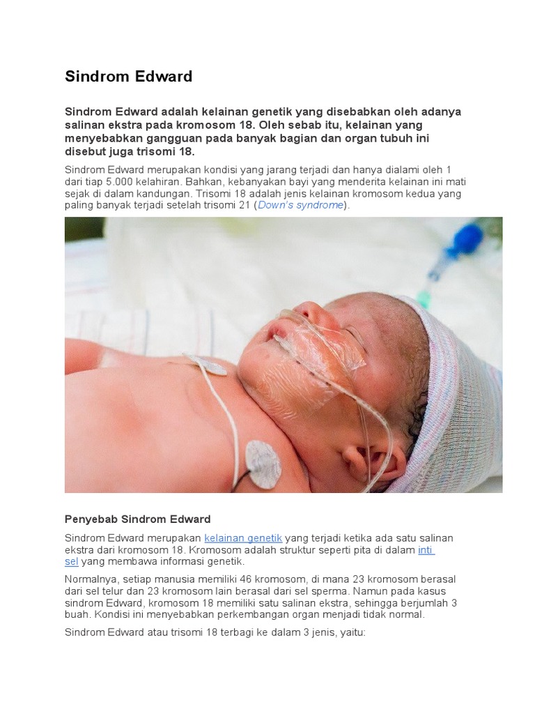 Sindrom Edward: Trisomi 18 dan Gejalanya | PDF