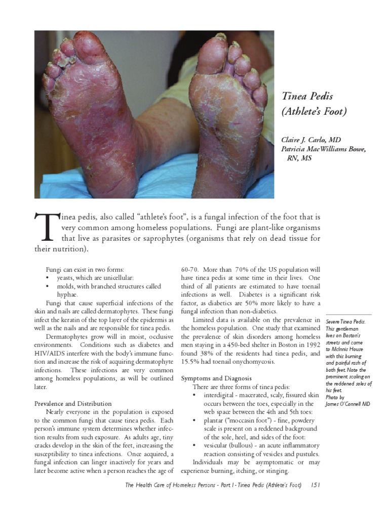 Tinea Pedis | PDF | Clinical Medicine | Medicine
