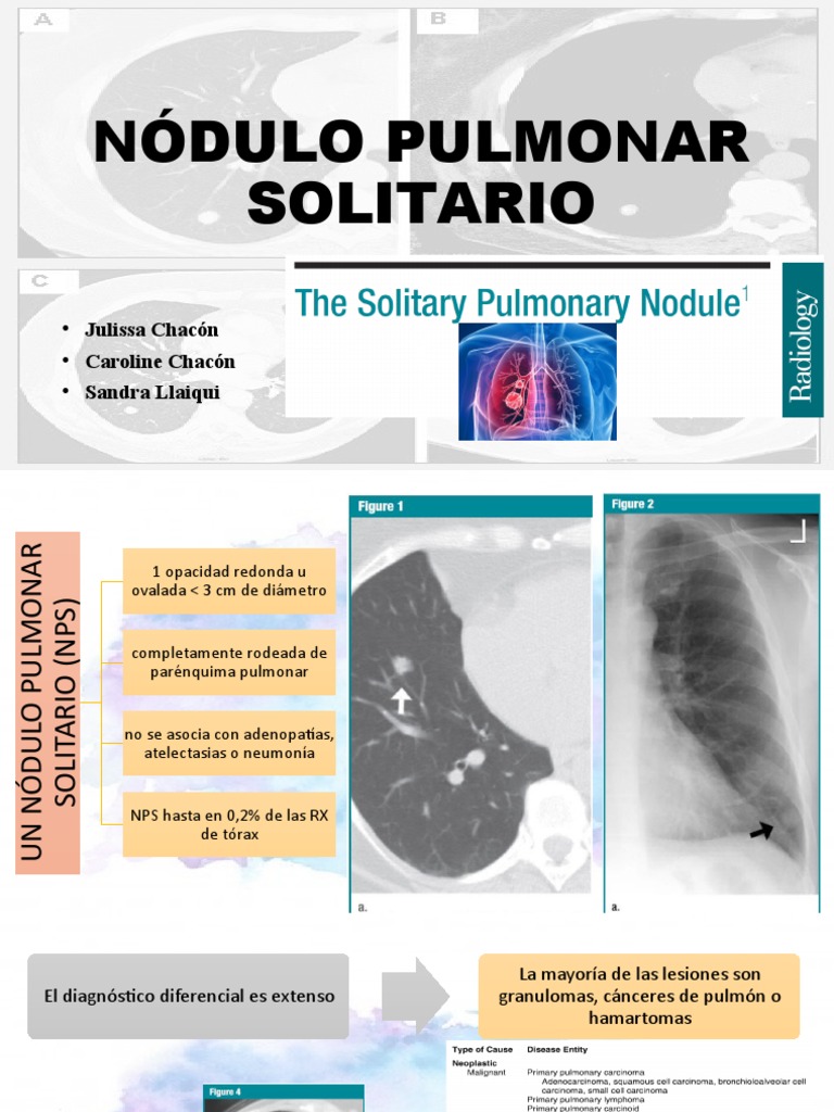 Nódulo Pulmonar Solitario 1.0 | PDF | Cáncer de pulmón | Tomografía de emisión de positrones