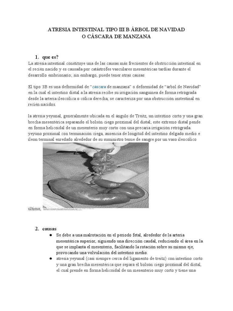 Atresia Tipo III B | PDF | Tracto gastrointestinal | Intestino delgado