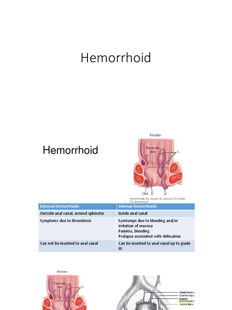 Understanding Hemorrhoids: Types & Treatments | PDF | Science & Mathematics