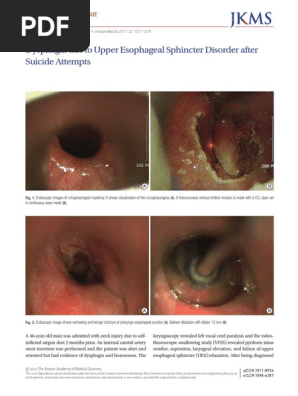 Upper Esophageal Sphincter Dysfunction