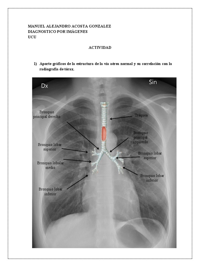 Aporte Gráficos de Las Estructura de La Vía Aérea Normal y Su ...