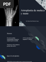 Mano en Garra | PDF | Mano | Extremidades (anatomía)