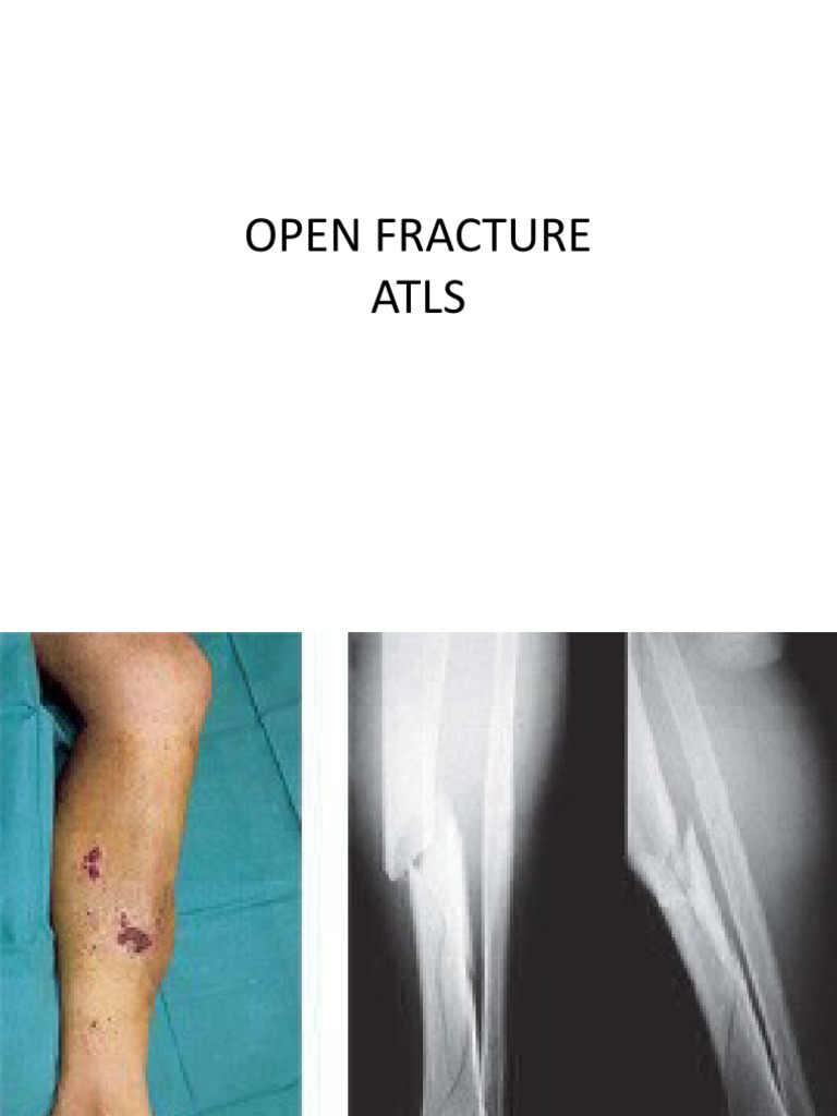 Open Fracture Atls | PDF
