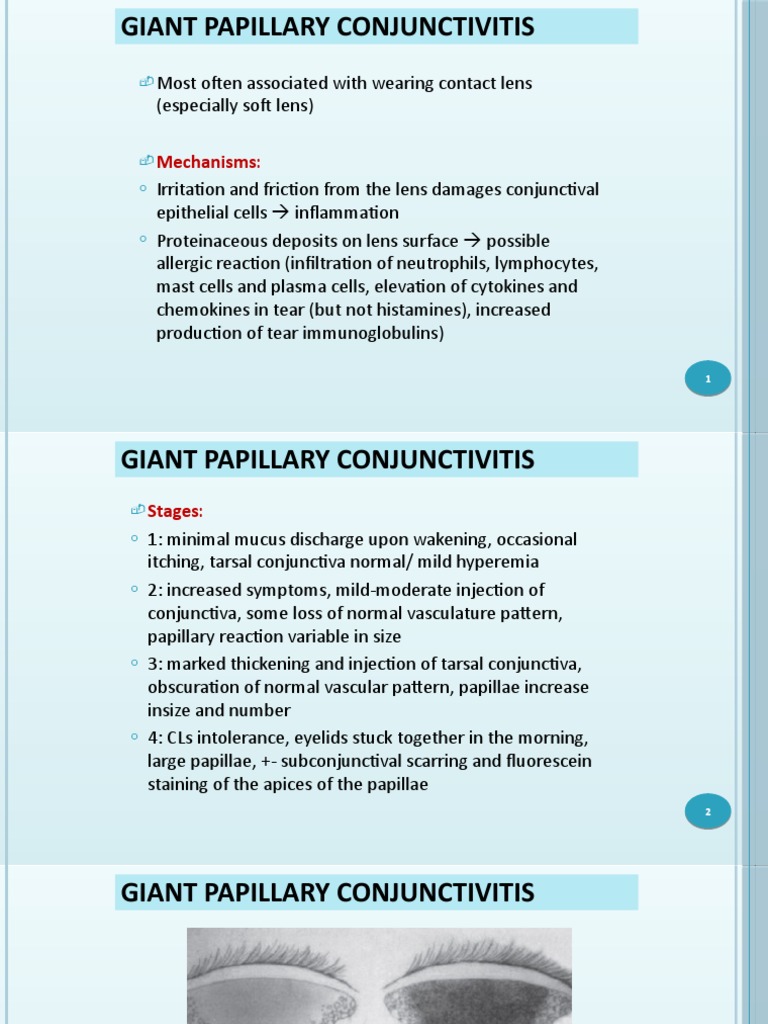 Giant Papillary Conjunctivitis | PDF