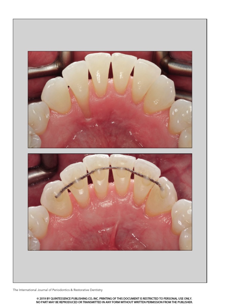 The International Journal of Periodontics & Restorative Dentistry | PDF ...