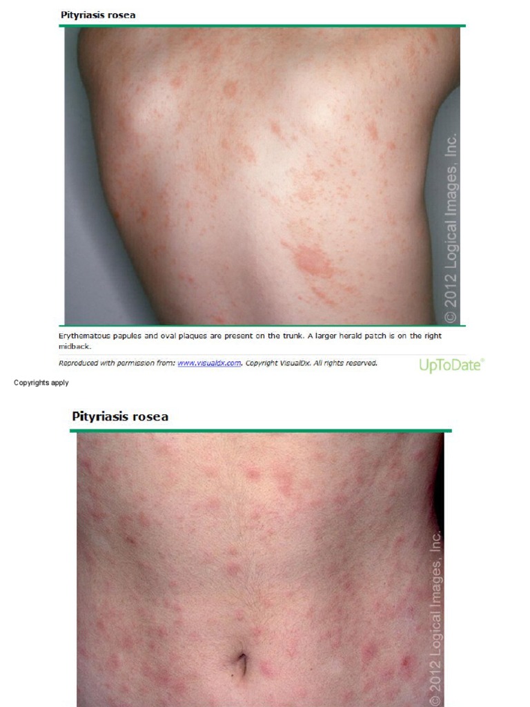 Pityriasis Rosea Herald Patch