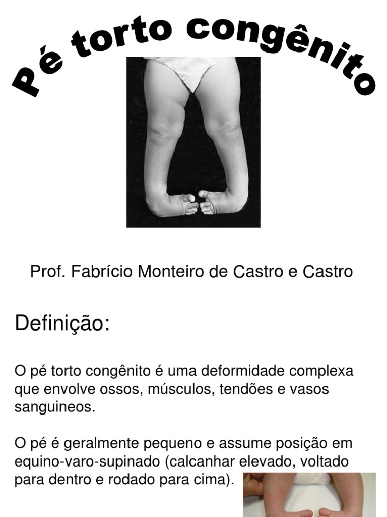Aula Pé Torto Congênito | PDF | Músculo | Flexibilidade (anatomia)