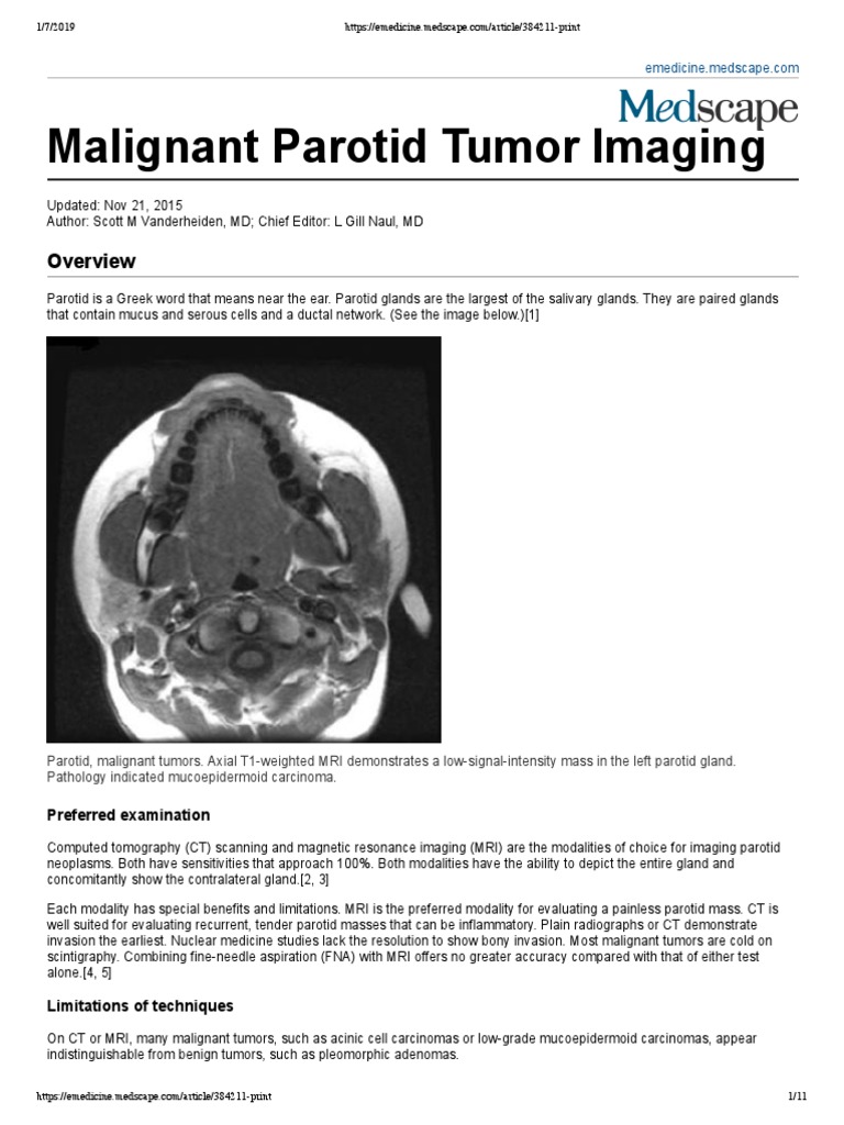 Malignant Parotid Tumor Imaging | PDF | Medical Imaging | Adenoma