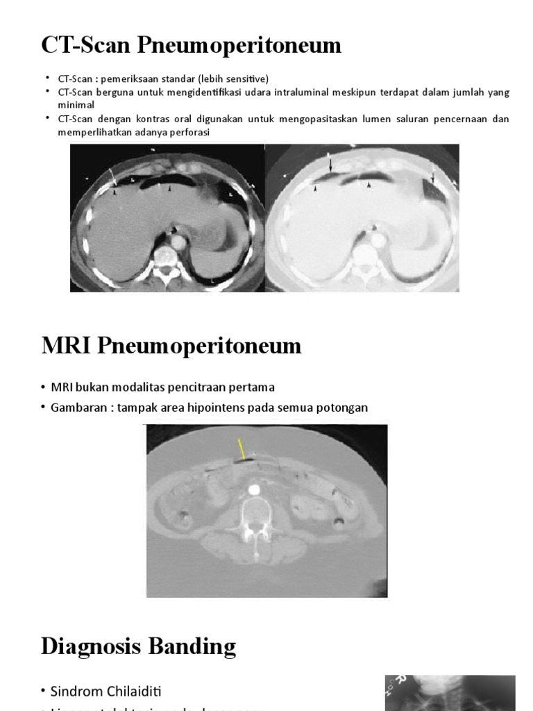 Referat Pneumoperitoneum | PDF