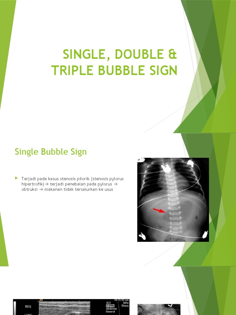 Single, Double & Triple Bubble Sign | PDF