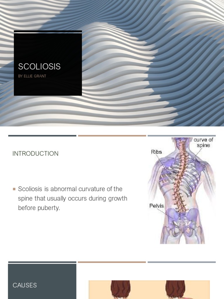 Scoliosis Presentation | PDF