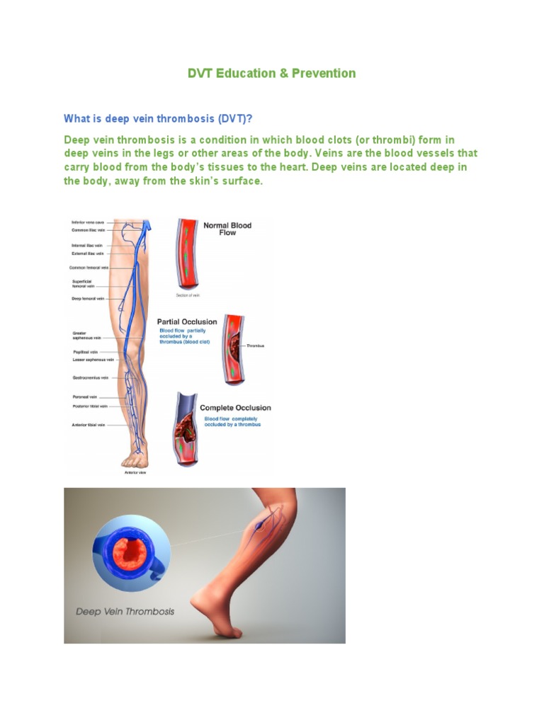 DVT Prevention Education | PDF | Vein | Thrombosis