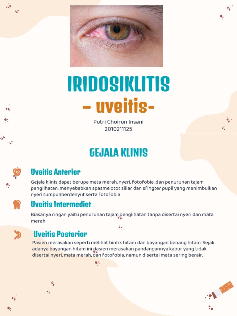 10 Iridosiklitis | PDF