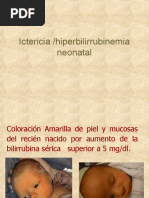 Ictericia Neonatal | PDF | Especialidades Medicas | Medicina CLINICA