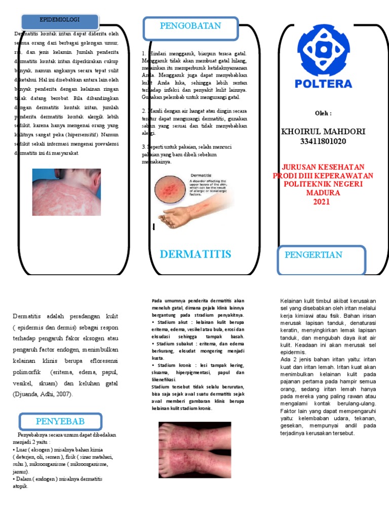 Leaflet Dermatitis Atopik | PDF