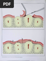 Miller Classification of Marginal Tissue | PDF | Periodontology ...