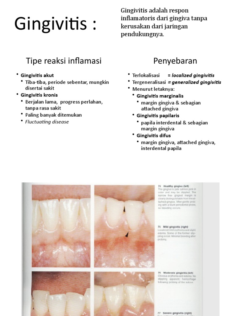 Perbedaan Gingivitis Dan Periodontitis | PDF