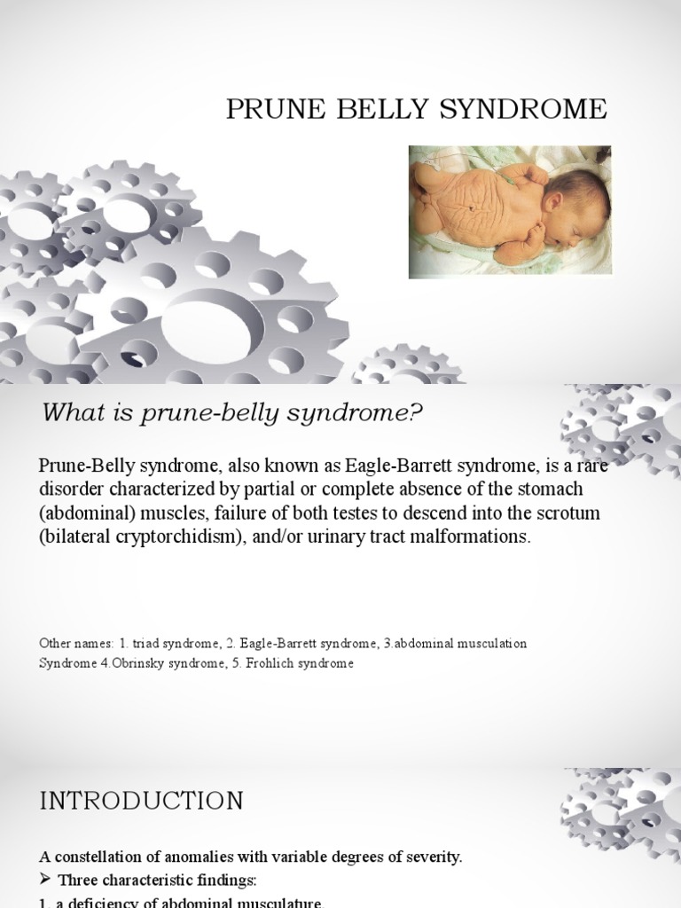 Prune Belly Syndrome Pdf Urology Genitourinary System