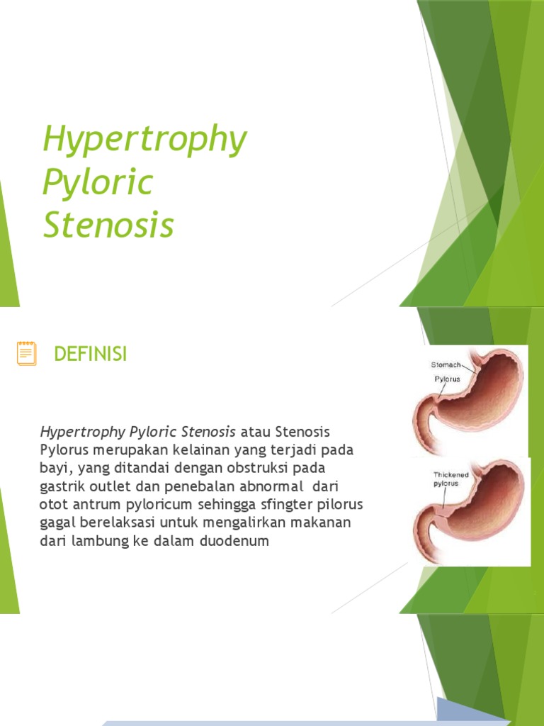 Hypertrophy Pyloric Stenosis | PDF | Sains & Matematika