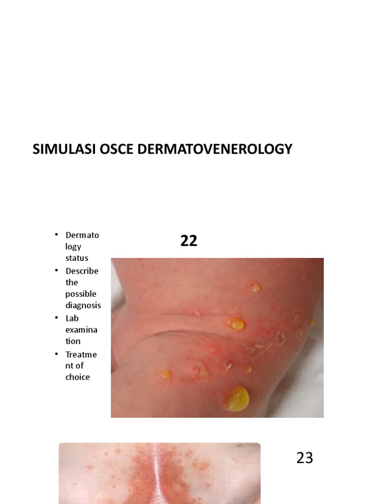Simulasi Osce Dermatovenerology | PDF | Medical Specialties | Dermatology