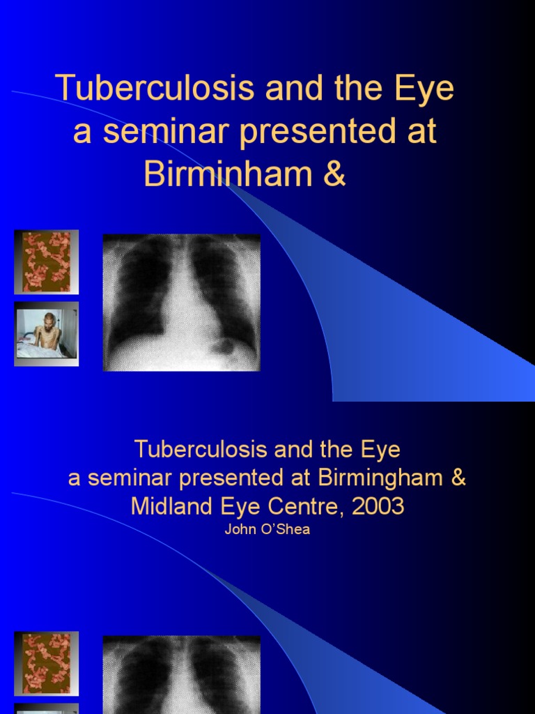 An Overview of Tuberculosis and its Ocular Manifestations: A Seminar on ...