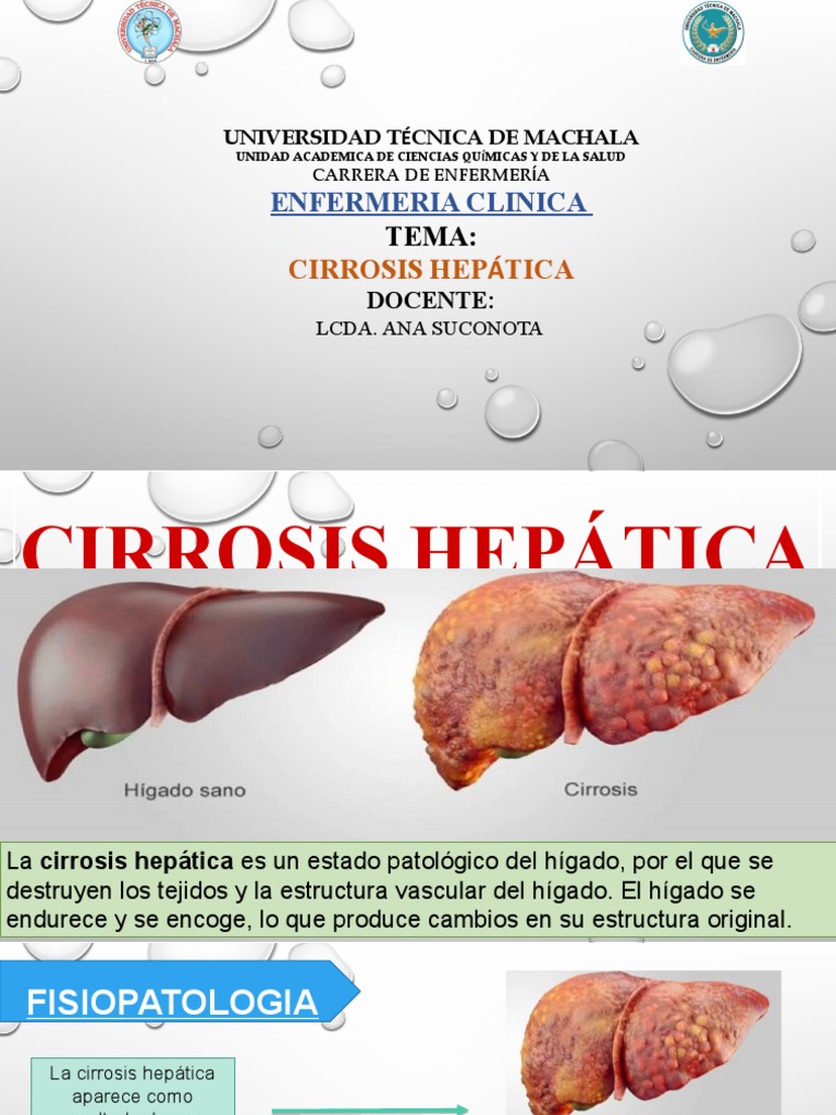 Cirrosis Hepatica | PDF | Cirrosis | Hepatitis C