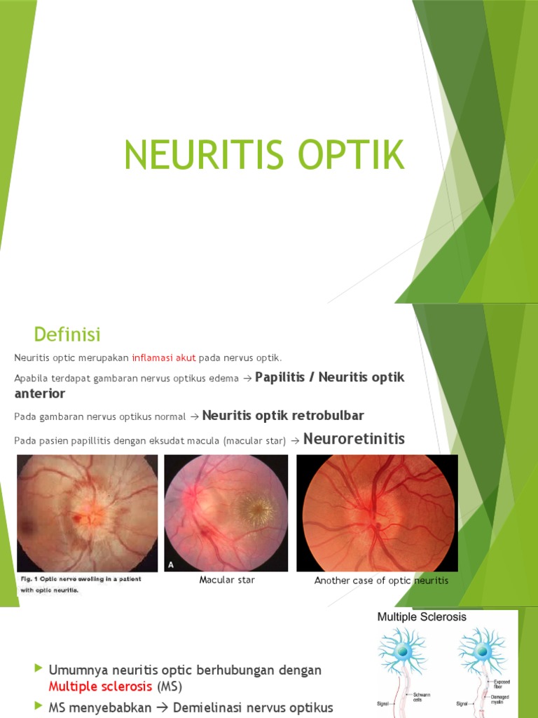 Neuritis Optik | PDF