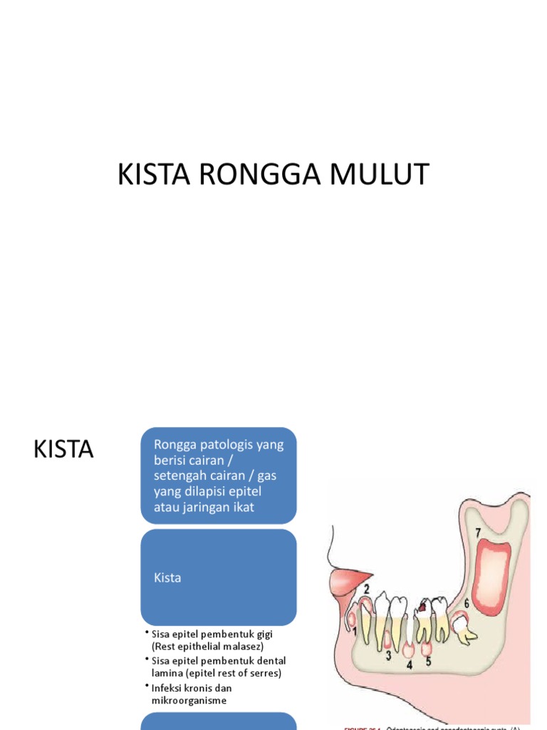 Patogenesis dan Jenis-jenis Kista Rongga Mulut | PDF