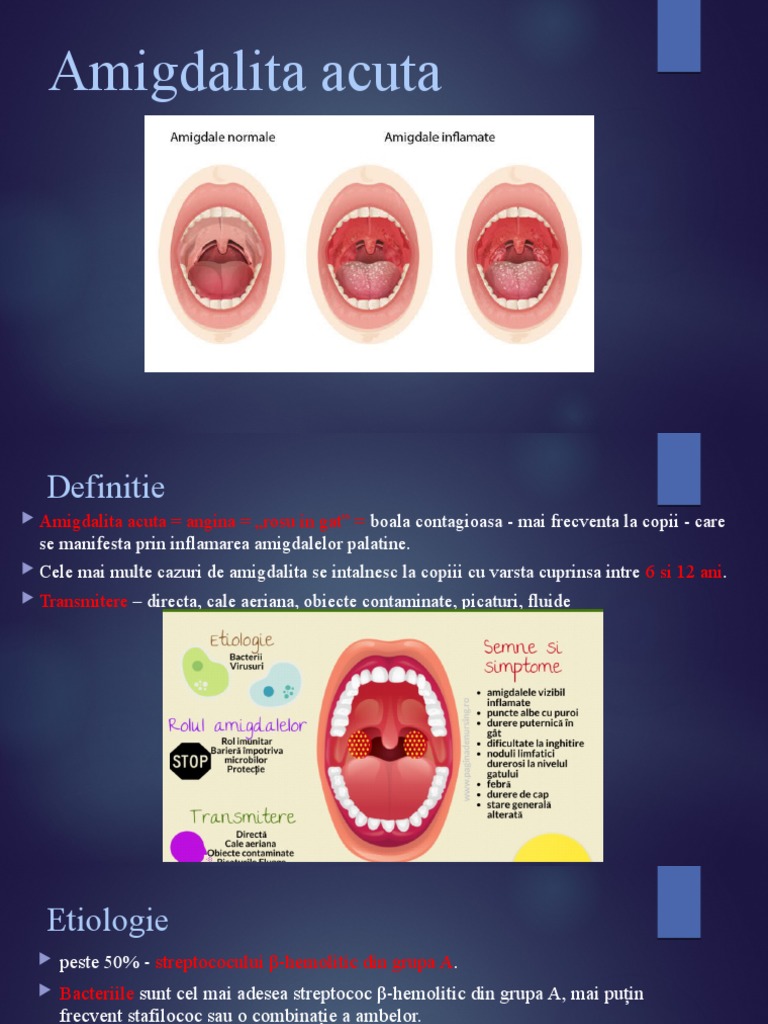 Amigdalita Acuta | PDF