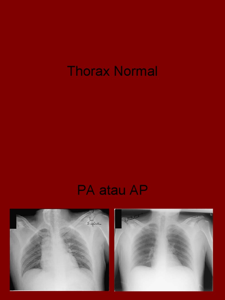 Thorax Normal | PDF | Aorta | Lung
