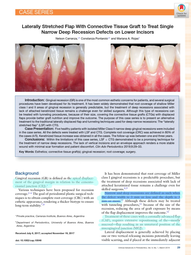 Laterally Stretched Flap With Connective Tissue Graft To Treat Single ...