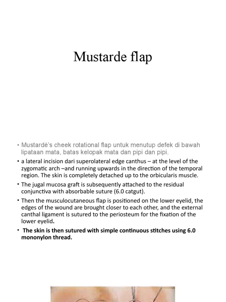 Mustarde Flap | PDF