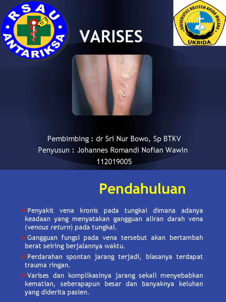 Varises: Penyakit Vena Tungkai | PDF
