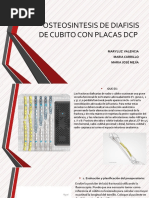 Placa Philos Técnica Cirúrgica | PDF | Tornillo | Cirugía