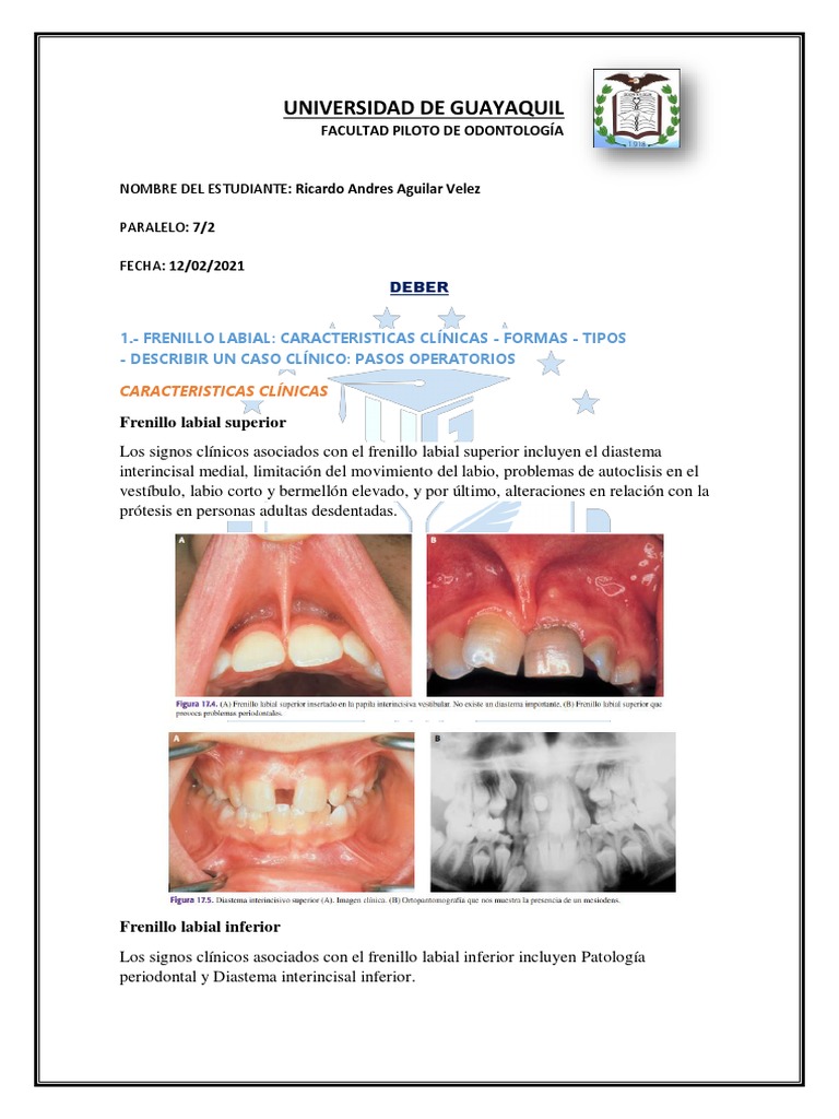 Frenillo Lingual y Labial | Descargar gratis PDF | Boca | Anatomía humana